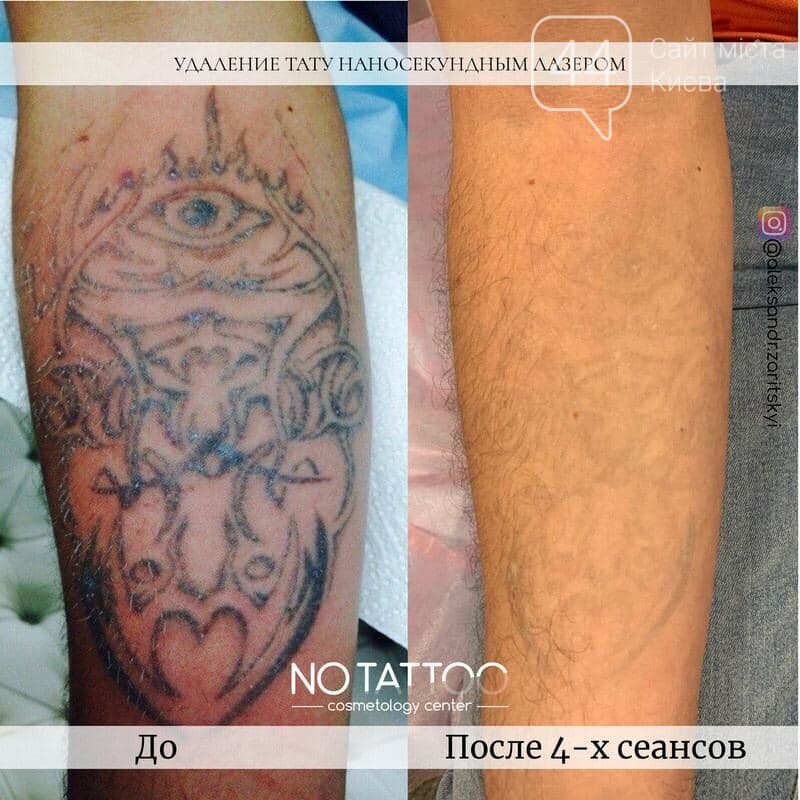 Лазерное удаление тату и татуажа наносекундным и пикосекундным лазерам ...